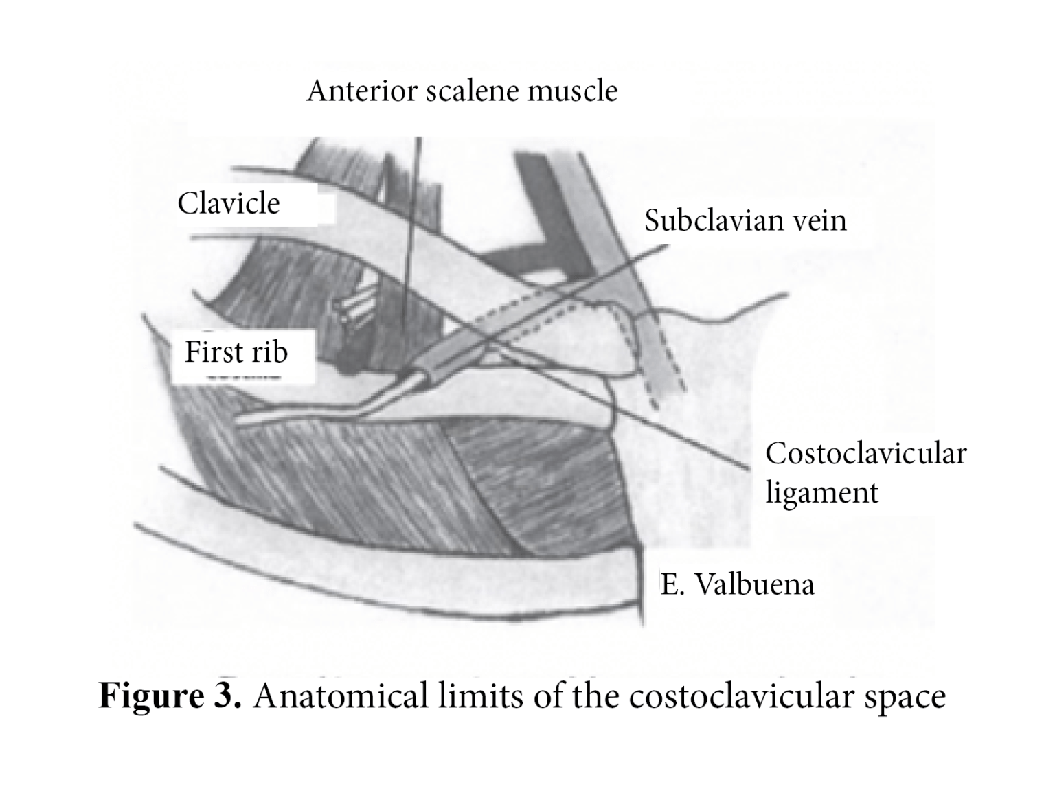 Complications in ports: pinch off syndrome - VascuFirst