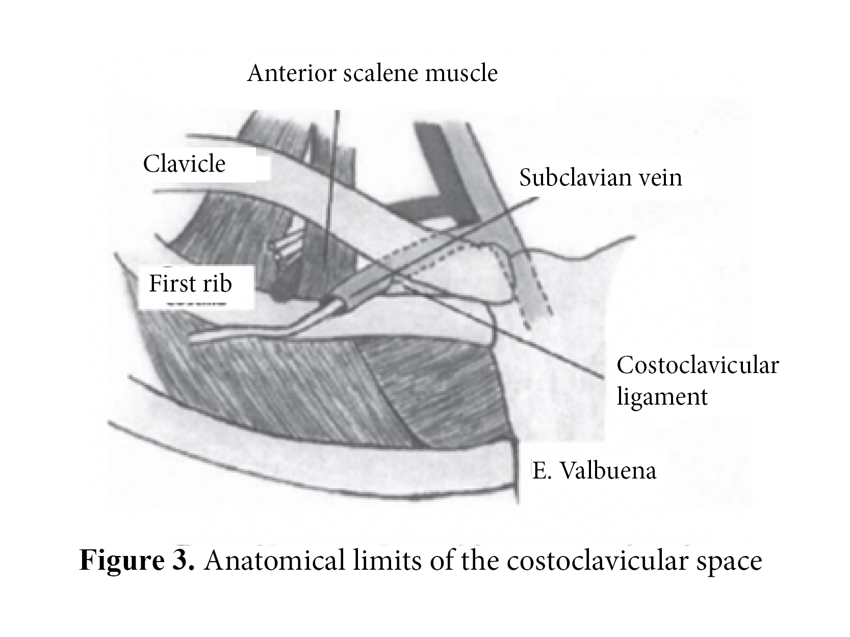 Complications in ports: pinch off syndrome - VascuFirst