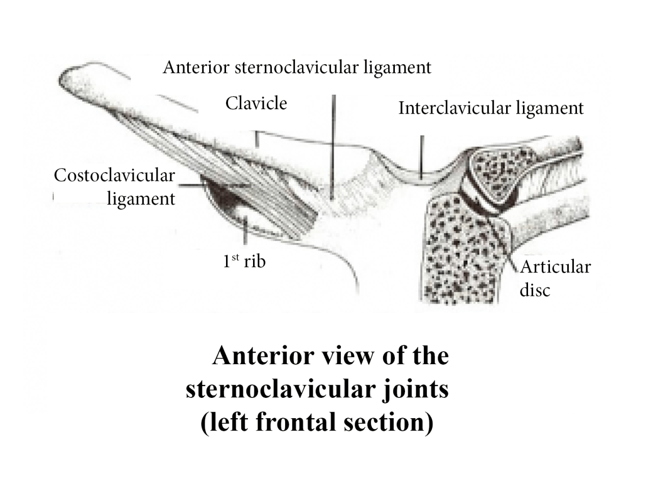 Complications in ports: pinch off syndrome - VascuFirst
