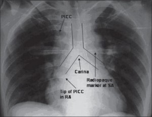 How to locate the tip of a PICC - VascuFirst