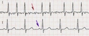 PICC placement in patients with Atrial Fibrillation - VascuFirst