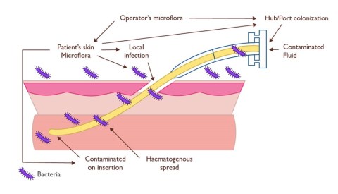 The routes of vascular access device infections - VascuFirst
