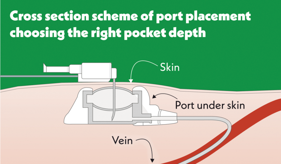 Combining aesthetics and feasibility in chest port placement - VascuFirst