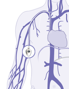 Combining aesthetics and feasibility in PICC-port placement - VascuFirst