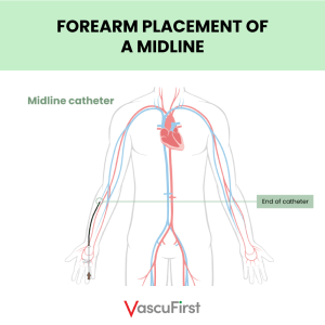 Peripherally inserted central catheters (PICCs): The key principles ...