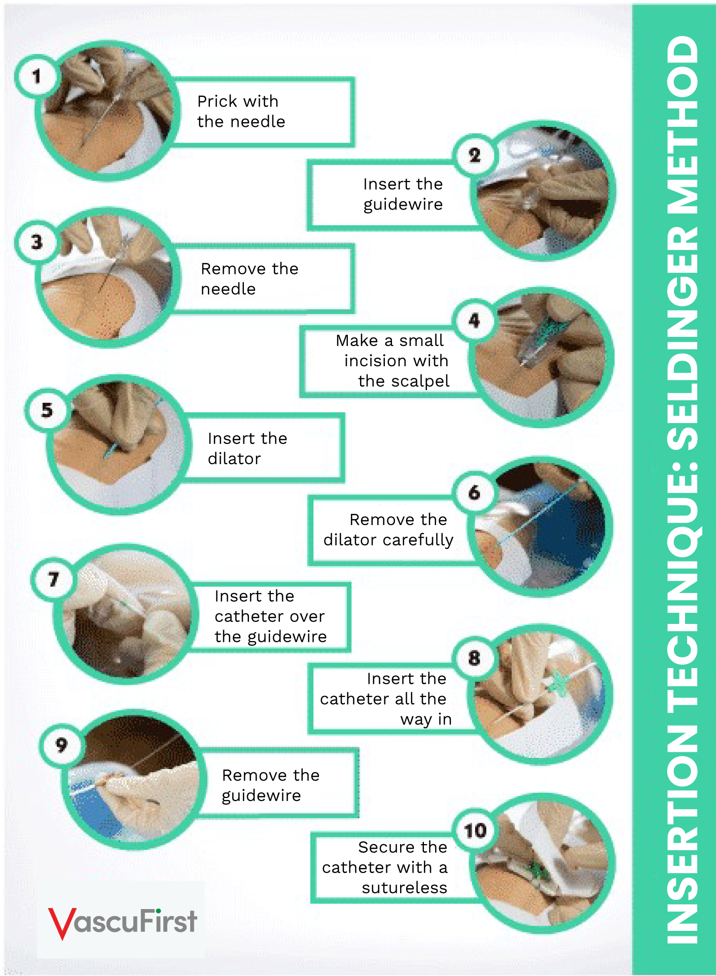 Midline catheter: placement and maintenance protocol - VascuFirst