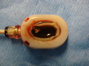 Mechanical complications of implantable ports - A testimonial of Dr ...