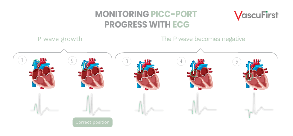6 measures to ensure the proper functioning of a PICC-port - VascuFirst