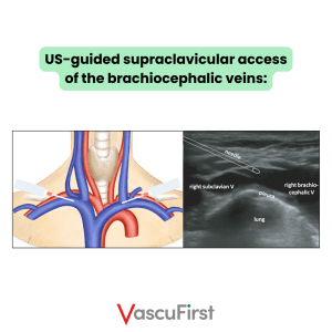 Specificities of central venous access in paediatrics - VascuFirst
